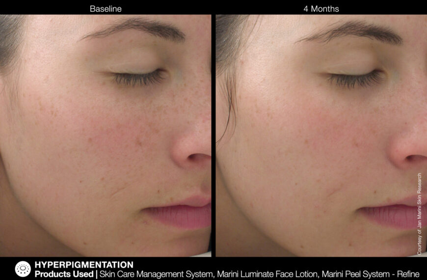 Jan Marini Before & Afters - Clever Beauty