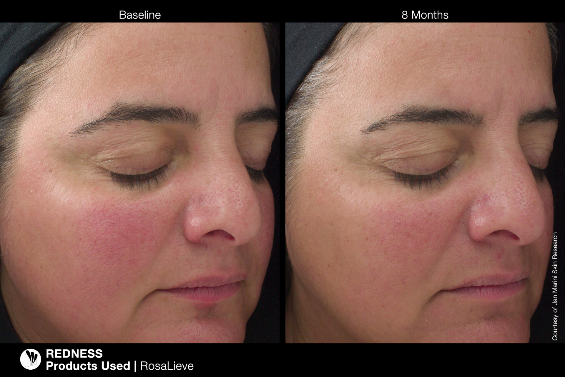 Jan Marini Before & Afters - Redness - Clever Beauty
