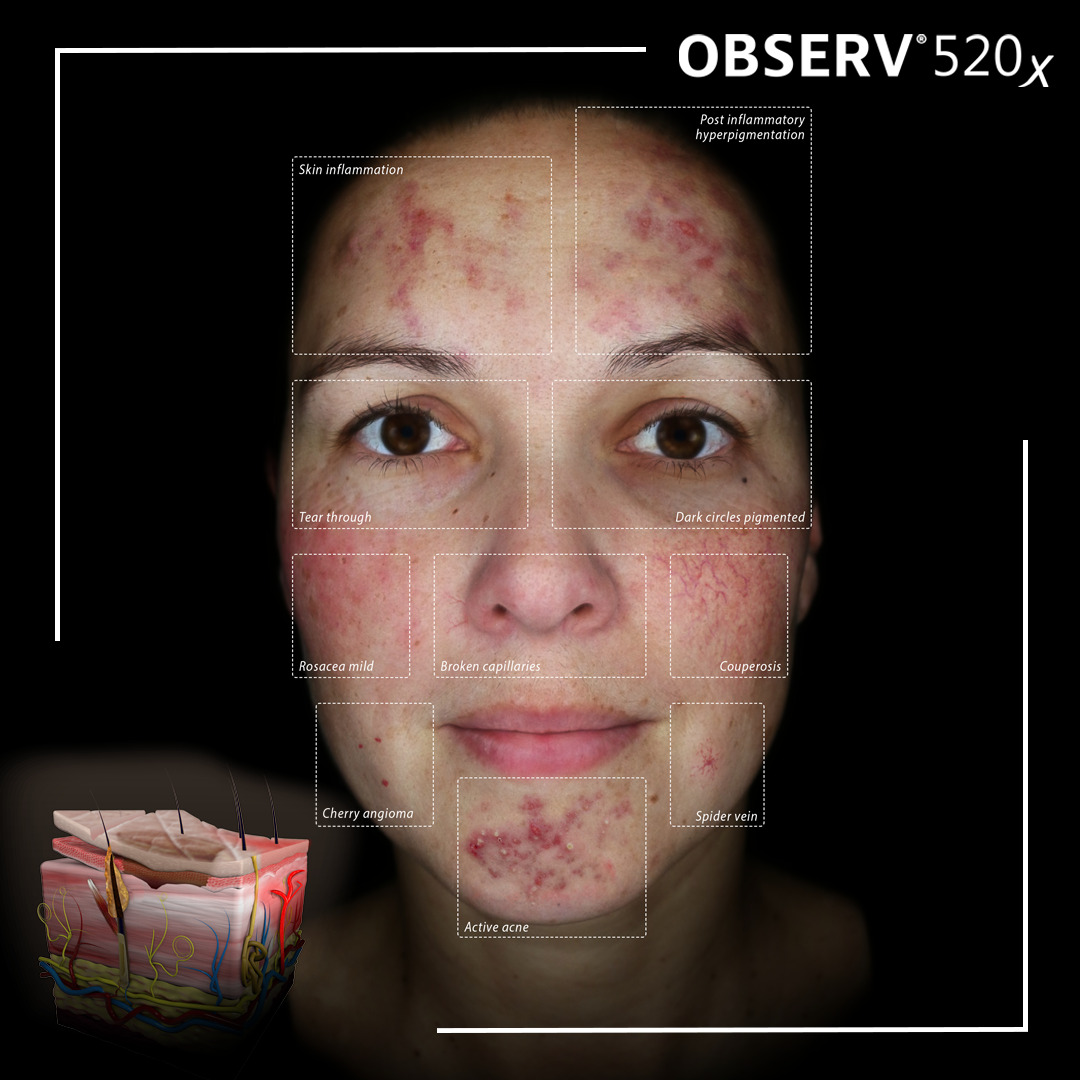 OBSERV® 520x Social Media - Clever Beauty